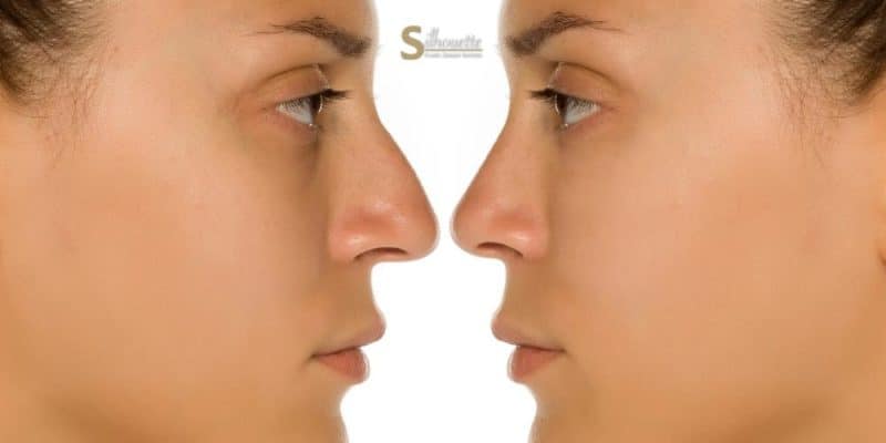 Pollybeak Deformity Rhinoplasty | Pollybeak Deformity Treatment
