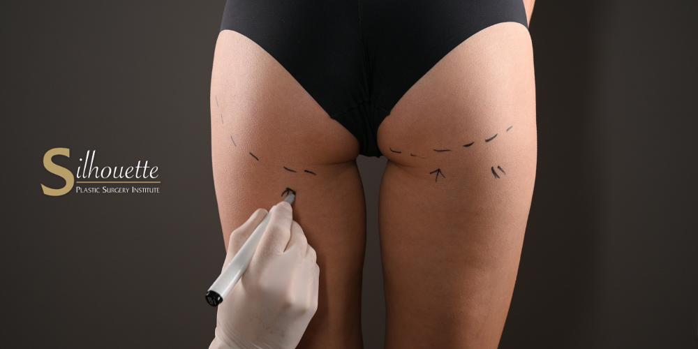 BBL Recovery | Silhouette Plastic Surgery Institute